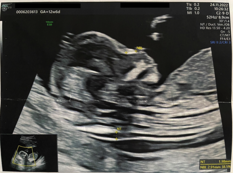ドイツで妊娠！＜12w6d＞初期胎児スクリーニング＆NIPT！ | ドイツでの Bean!! な毎日